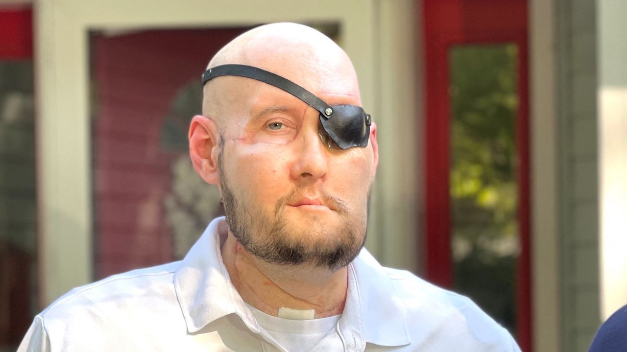 Más de veinte horas de cirugía para el primer trasplante de todo el ojo y de cara parcial del mundo