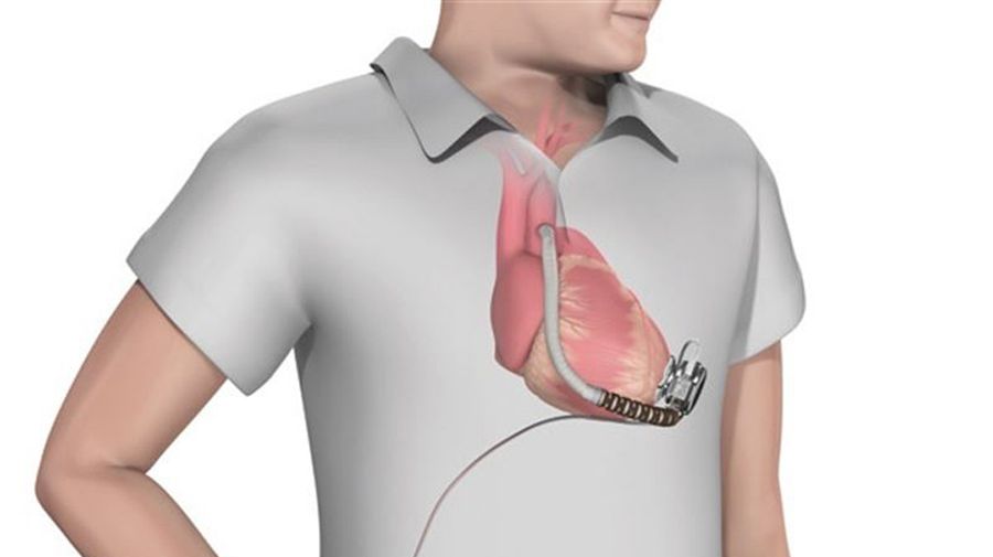 «Corazones artificiales» como sustitutos al transplante