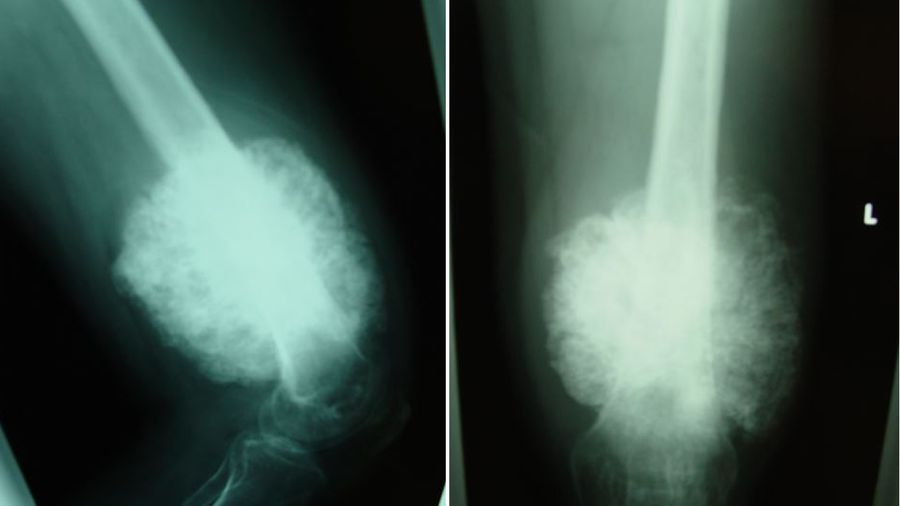 Todo sobre el osteosarcoma, el cáncer que padecía la hija de Luis Enrique