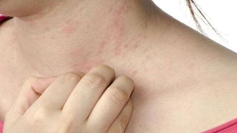 Los dermatólogos alertan del repunte de la sarna a raíz de la pandemia