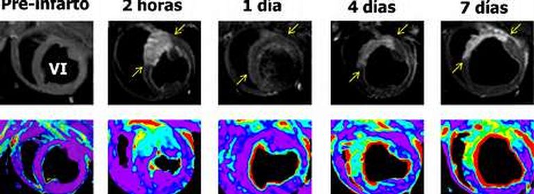 El corazón infartado se repara en dos fases, lo que cambiará el tratamiento