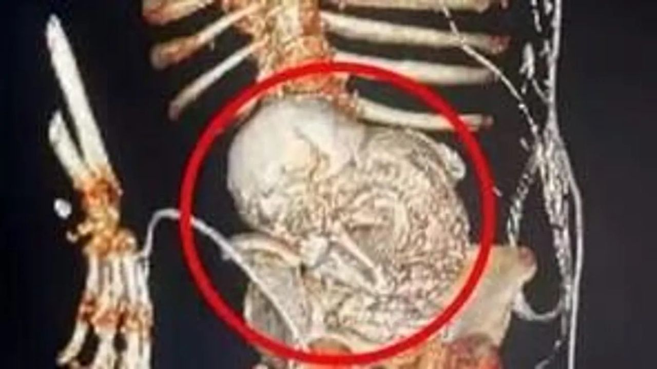 Muere una mujer al retirarle un «bebé de piedra» que tenía desde hace ...