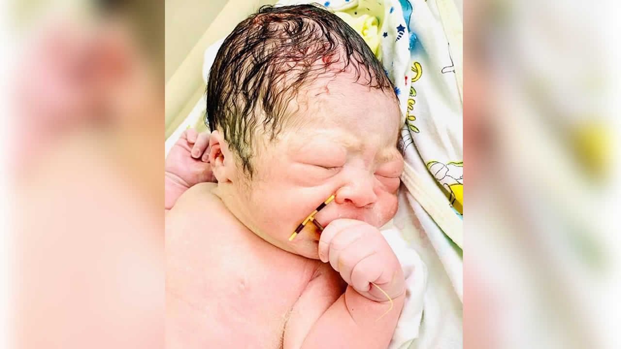 Nace un bebé con el DIU de su madre en la mano